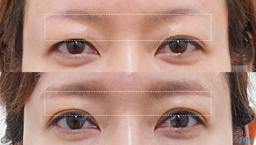 Revision Eye Surgery - Upper Blepharoplasty - JW Plastic Surgery